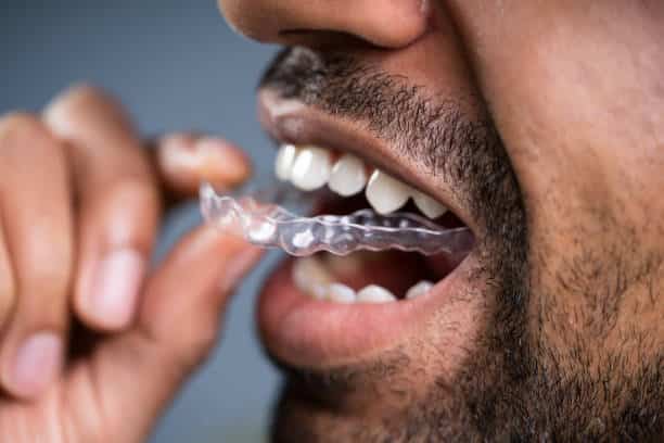 Aligners and Clear Braces