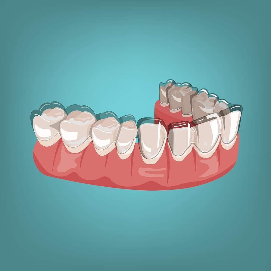 What is Invisalign?